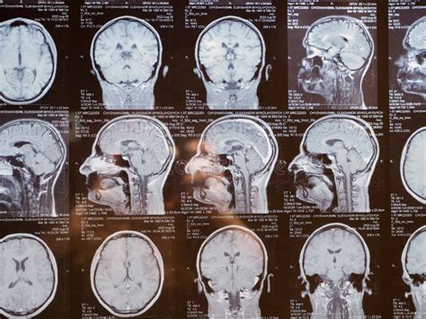 Mri Human Brain With Multiple Sclerosis Stock Image Image Of Medical Scanner 336707201