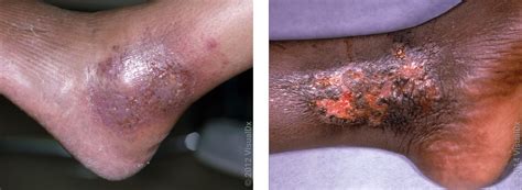 Venous Stasis Dermatitis Images Causes And Treatment Goodrx