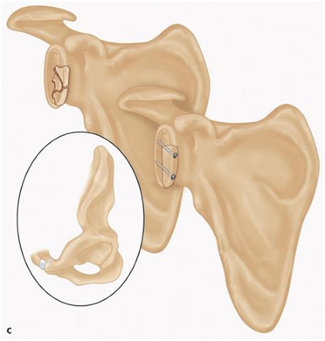 Open Reduction And Internal Fixation Of Intra Articular Scapular Fractures Musculoskeletal Key