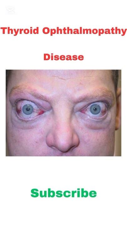 Thyroid Ophthalmopathy Viral Viralshorts Medical Youtube