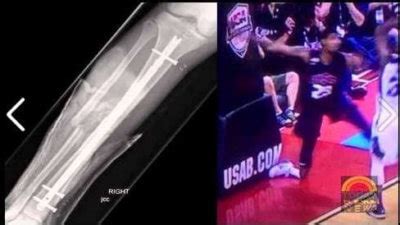 Injury Of The Week Compound Fracture Of The Tibia And Fibula Symmetry Physiotherapy