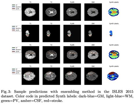 synthetic data for robust stroke segmentation liam chalcroft