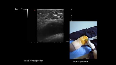 Ultrasound Guided Knee Joint Aspiration And Steroid Injection 2 Youtube