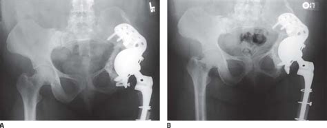 Triflange Cup Musculoskeletal Key