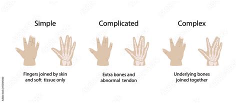 Illustration Of Biology And Medical Types Of Hand Syndactyly