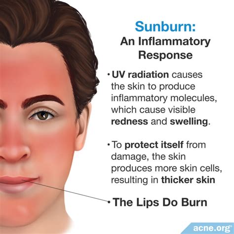 Lip Sun Protection Do Lips Burn Or Tan