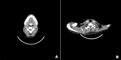 Clinical Photograph Showing Nodular Swelling On The Posterior Midline