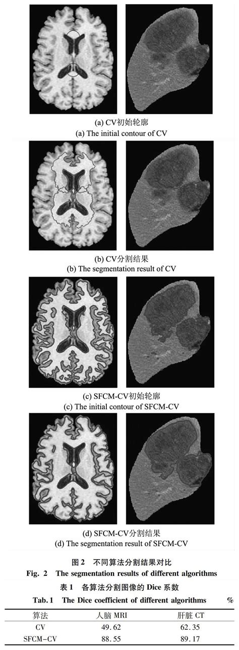 基于空间域模糊聚类与cv模型的医学图像分割 参考网