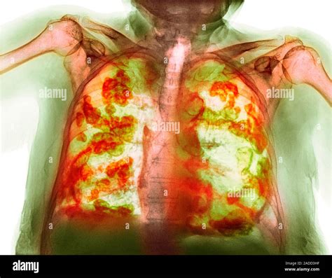 Bilateral Pleural Calcification Coloured X Ray The Pleura Are The Membranes That Surround The