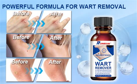 Ahuift Fast Acting Wart Remover Freeze Off 17 Salicylic