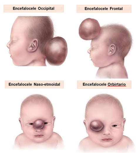 Defecto Del Cierre Del Tubo Neural Neurocirugia