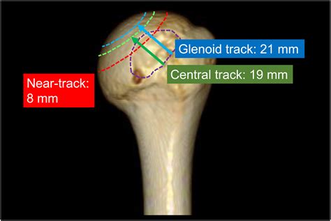 Glenoid Track And Subcritical Hill Sachs Lesion Jses International