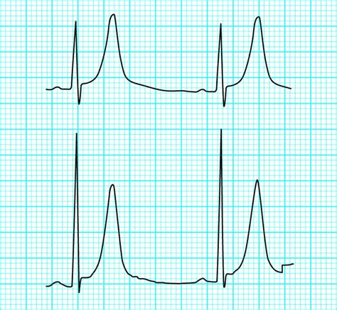 Myocardial Ischaemia The Bmj