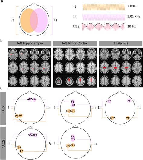 Interindividual Variability Of Electric Fields During Transcranial