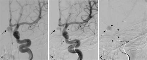 A Ap View Of The Dsa At The Onset Of The Endovascular Intervention