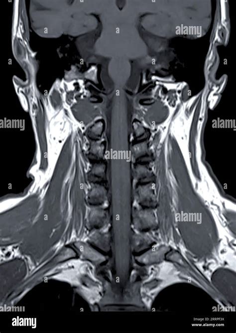 IRM du rachis cervical ou imagerie par résonance magnétique de la vue coronale du rachis ...