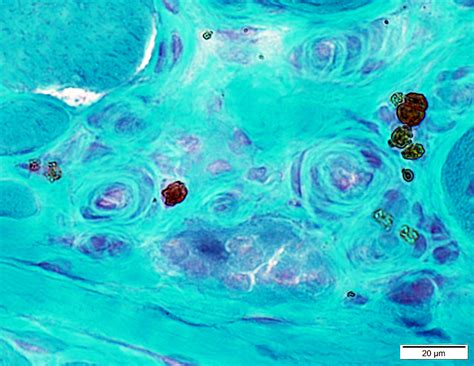 Hemosiderin