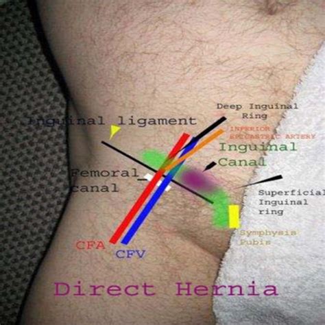 Superficial Inguinal Ring Superficial Inguinal Ring