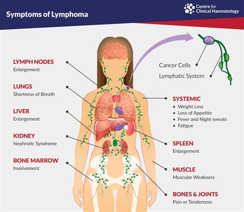 Lymphoma Signs Diagnosis And Treatments In Singapore