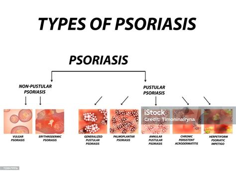 Jenis Psoriasis Pustular Dan Tidak Pustular Vulgar Eritrodima Psoriasis Eretrodermik