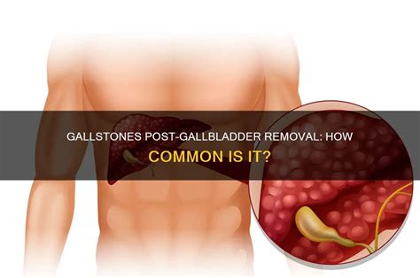 Gallstones Post Gallbladder Removal How Common Is It Medshun