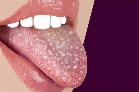 Canker Sore On The Tongue Causes Symptoms And Remedies 2020
