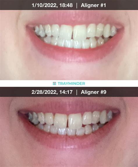 Can Anyone See A Difference R Invisalign