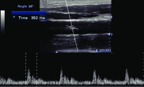 Measurements Of Time Carotid Artery Flow Download Scientific Diagram