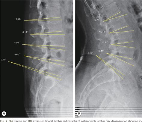 Lumbar Flexion And Extension X Rays At Michele Bodden Blog