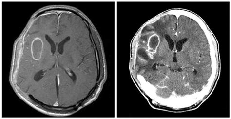 Gadolinium Enhanced Magnetic Resonance Image And Contrast Enhanced Ct