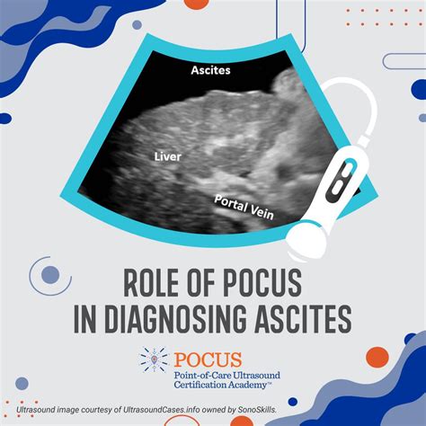 How Pocus Can Assess Ascites In Peritoneal Cavity Point Of Care