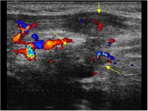 Head And Neck 41 Thyroid Gland Case 413 Thyroid Malignant