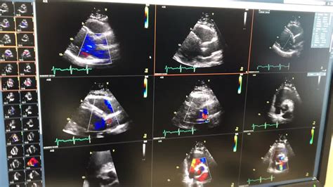 Cardiovascular Business On Linkedin Example Of Echo Reporting Workflow Efficiency Cardiovascular Business On Linkedin Example Of Echo Reporting Workflow Efficiency