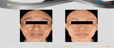 เทคนิครักษาหลุมสิวด้วย Sylfirm X Plus Fractional Rf Microneedle มีลักษณะพลังงานพิเศษ Pulsed