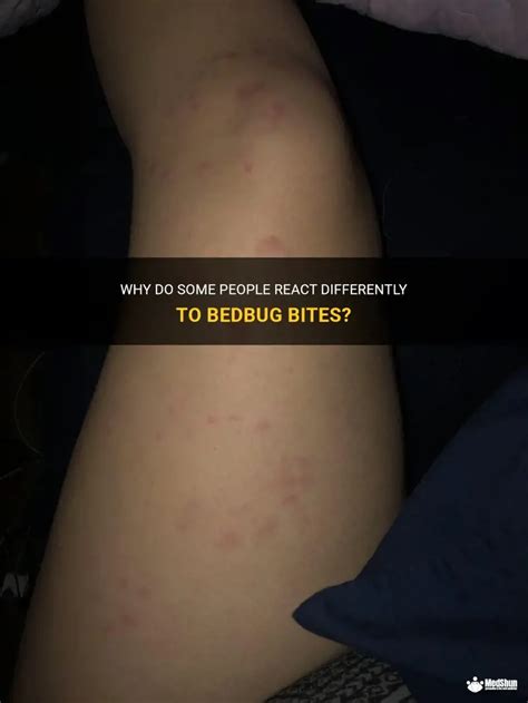 Why Do Some People React Differently To Bedbug Bites Medshun