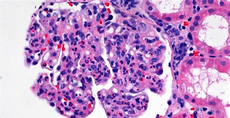 Nephromed Acute Diffuse Proliferative Gn Suggestive