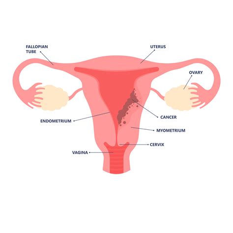 Endometrial Cancer Symptoms