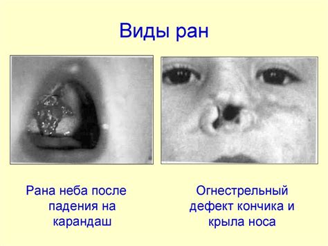 Травмы органов и тканей челюстно лицевой области у детей Online Presentation