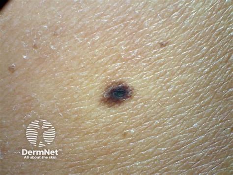 Lentigo Simplex
