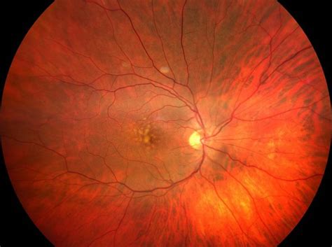 Retina E Vitreo Andrea Cusumano