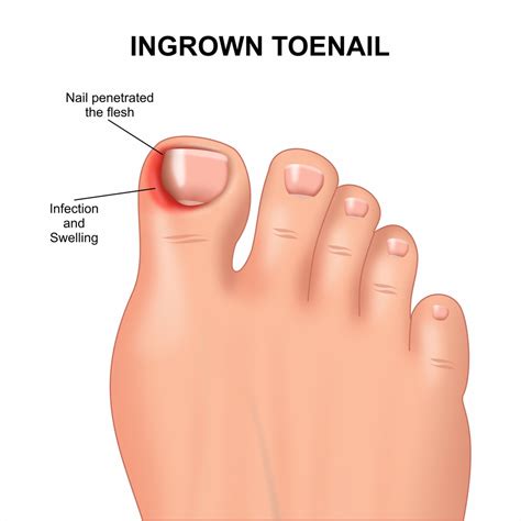 How To Prevent And Treat Ingrown Toenails