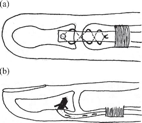 Figure 2 From The Outcomes Of Zone 1 Flexor Tendon Injuries Treated
