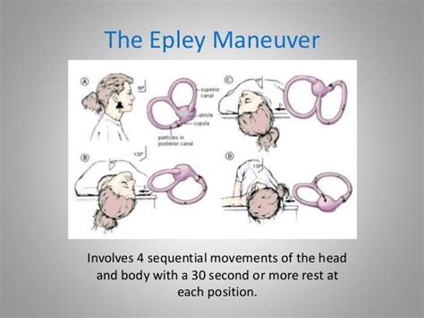 Brandt Daroff Exercises Epley Maneuver