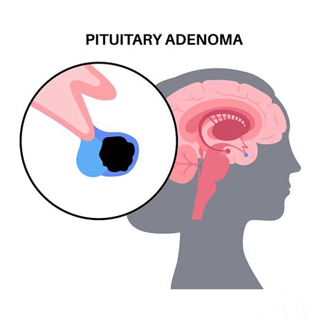 Pituitary Adenoma Cancer Photograph By Pikovit Science Photo Library