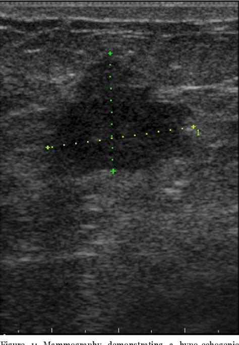 Figure 1 From Ocular Flutter As The First Sign Of A Breast Carcinoma