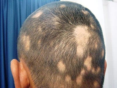 Alopecia Areata Hair Loss Causes Homeopathic Treatment