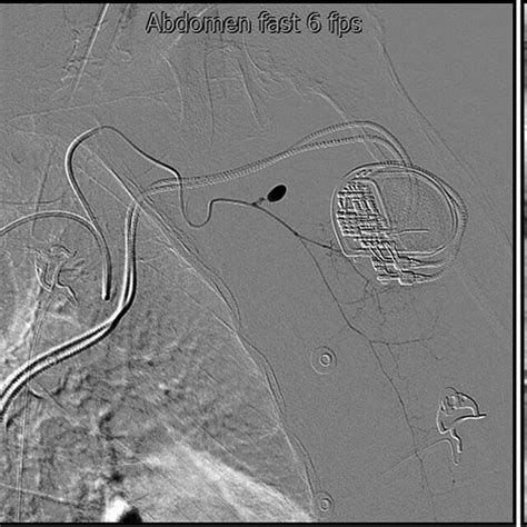Invasive Left Upper Limb Angiogram And Angioembolization Initial Download Scientific Diagram