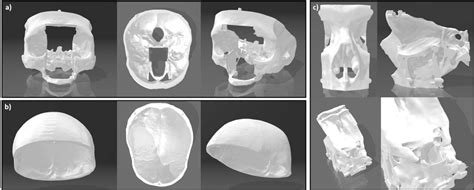 Computational Model Of The Skull Segmented From The Cbct Image The
