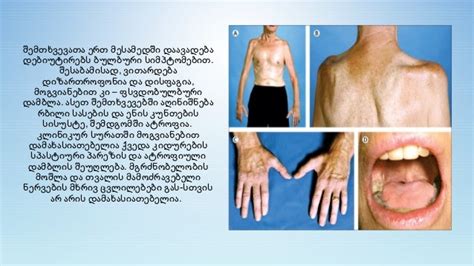 გვერდითი ამიოტროფული სკლეროზი