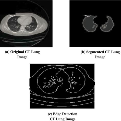 Segmented Ct Lung Image With Edge Detection Download Scientific Diagram